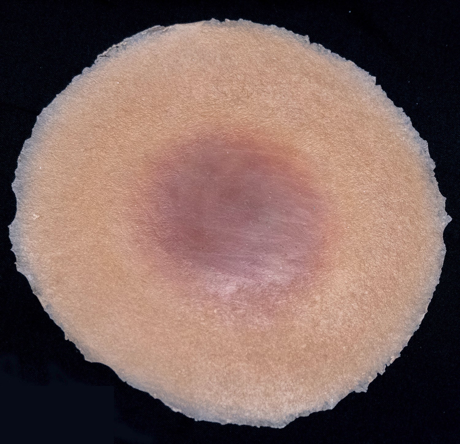 Stage 1 Pressure Injury – Techline Trauma