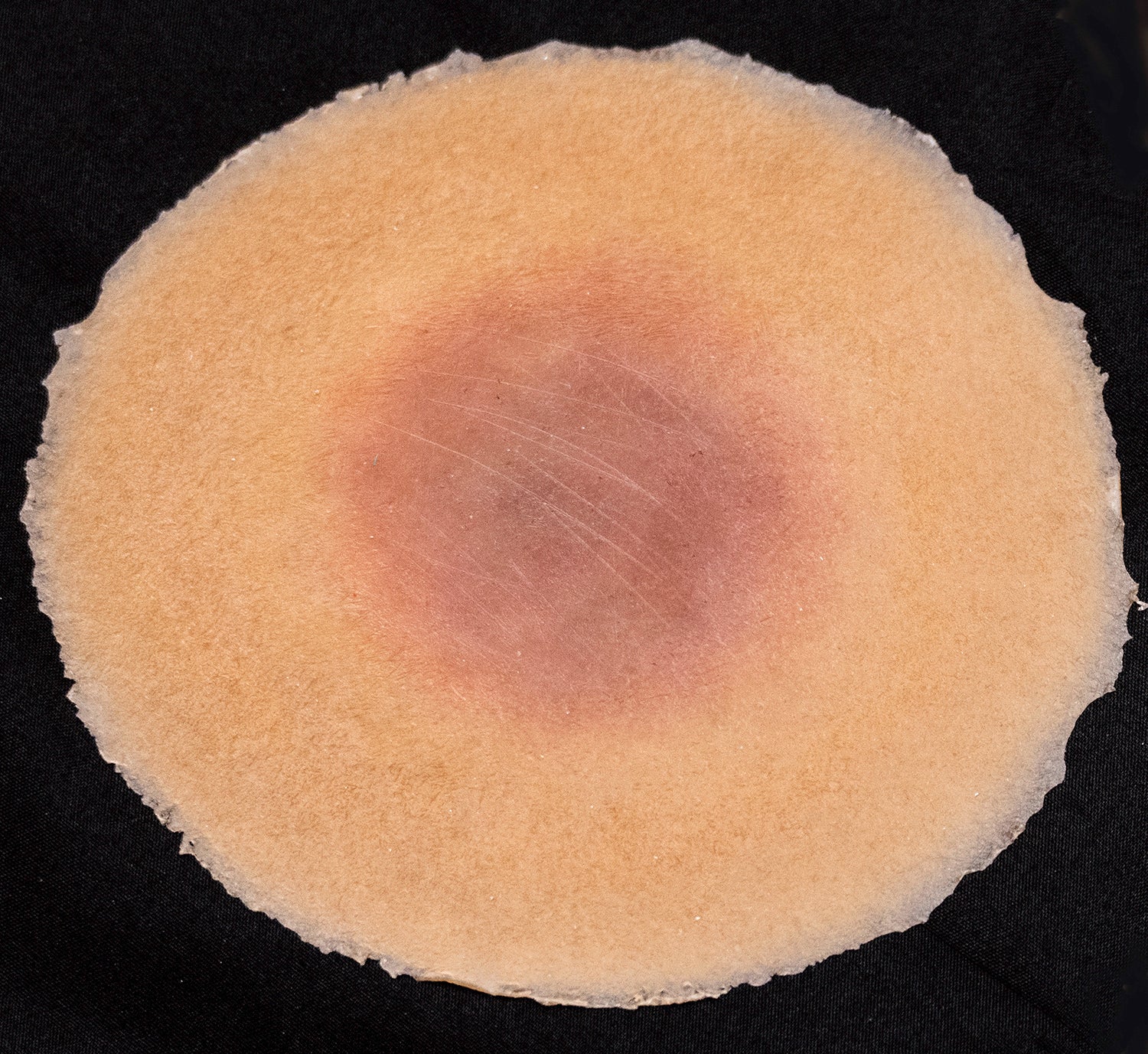 Stage 1 Pressure Injury – Techline Trauma