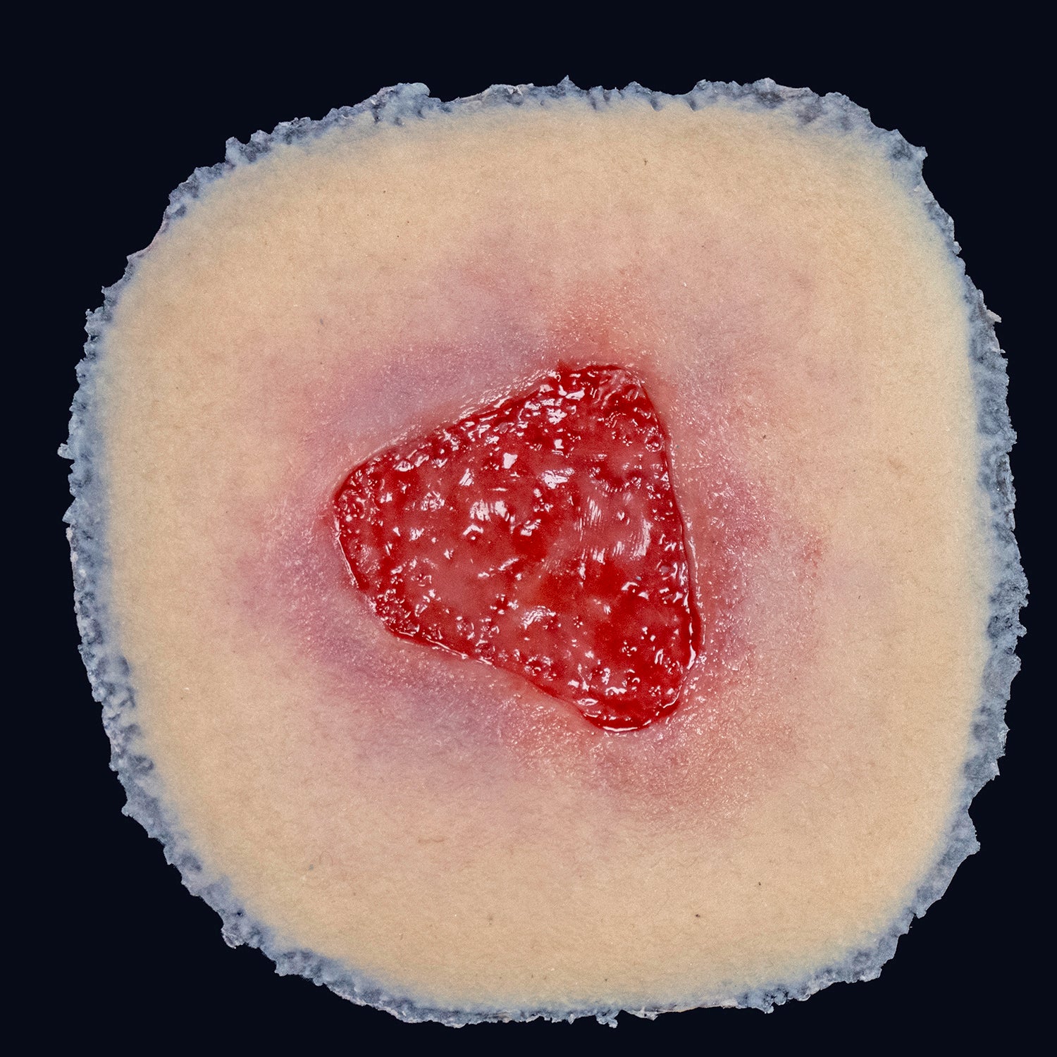 Stage 2 Pressure Injury – Techline Trauma